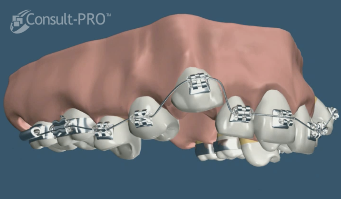Aparatología fija con brackets - Clínica médico odontológica Dr. Julio Tojo